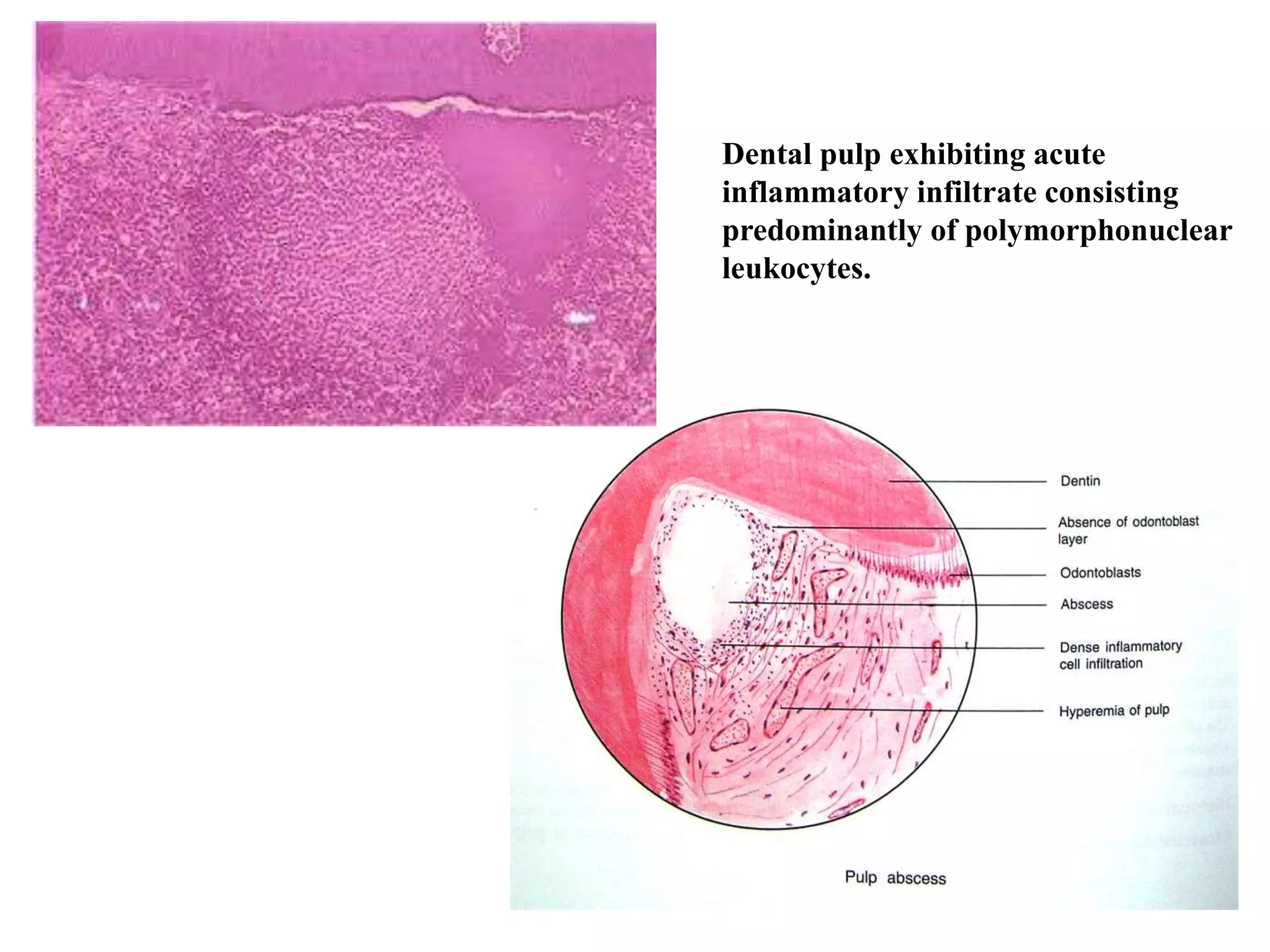 PULP AND PERIAPICAL LESIONS OF THE TOOTH ppt | PPTX