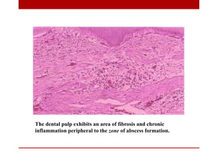PULP AND PERIAPICAL LESIONS OF THE TOOTH ppt | PPTX