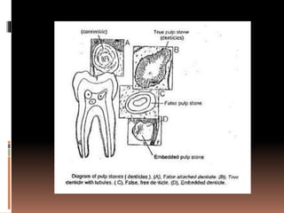 Pulp calcification | PPTX