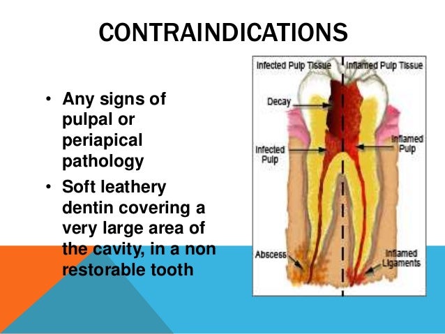Pulpcapping 141116104011-conversion-gate01