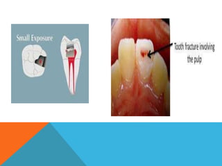 Pulp capping | PPTX