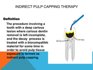 Pulp capping | PPTX