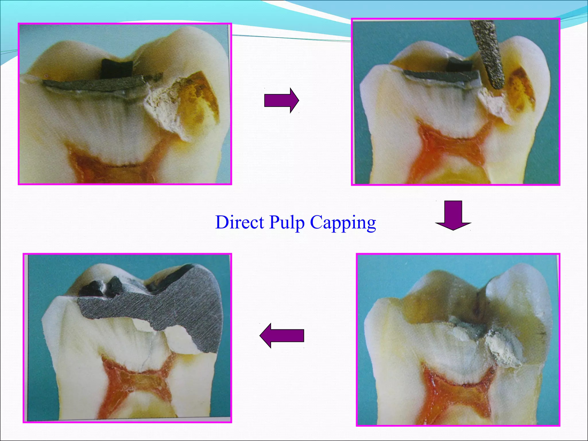 Pulp capping | PPT