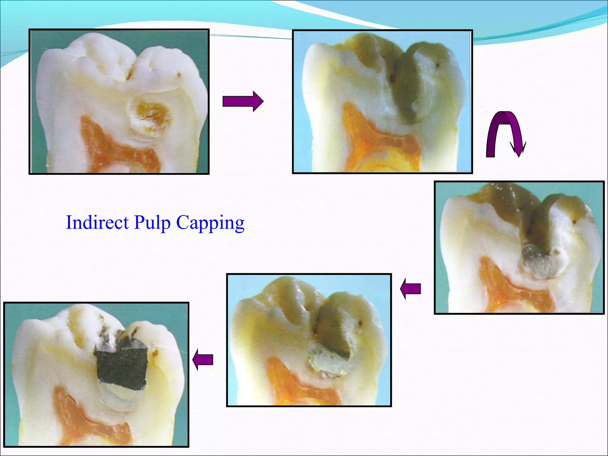 Pulp capping | PPT