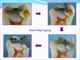 Pulp capping | PPT