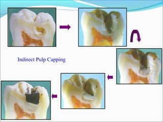 Pulp capping | PPT