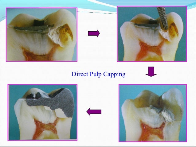 Pulp capping