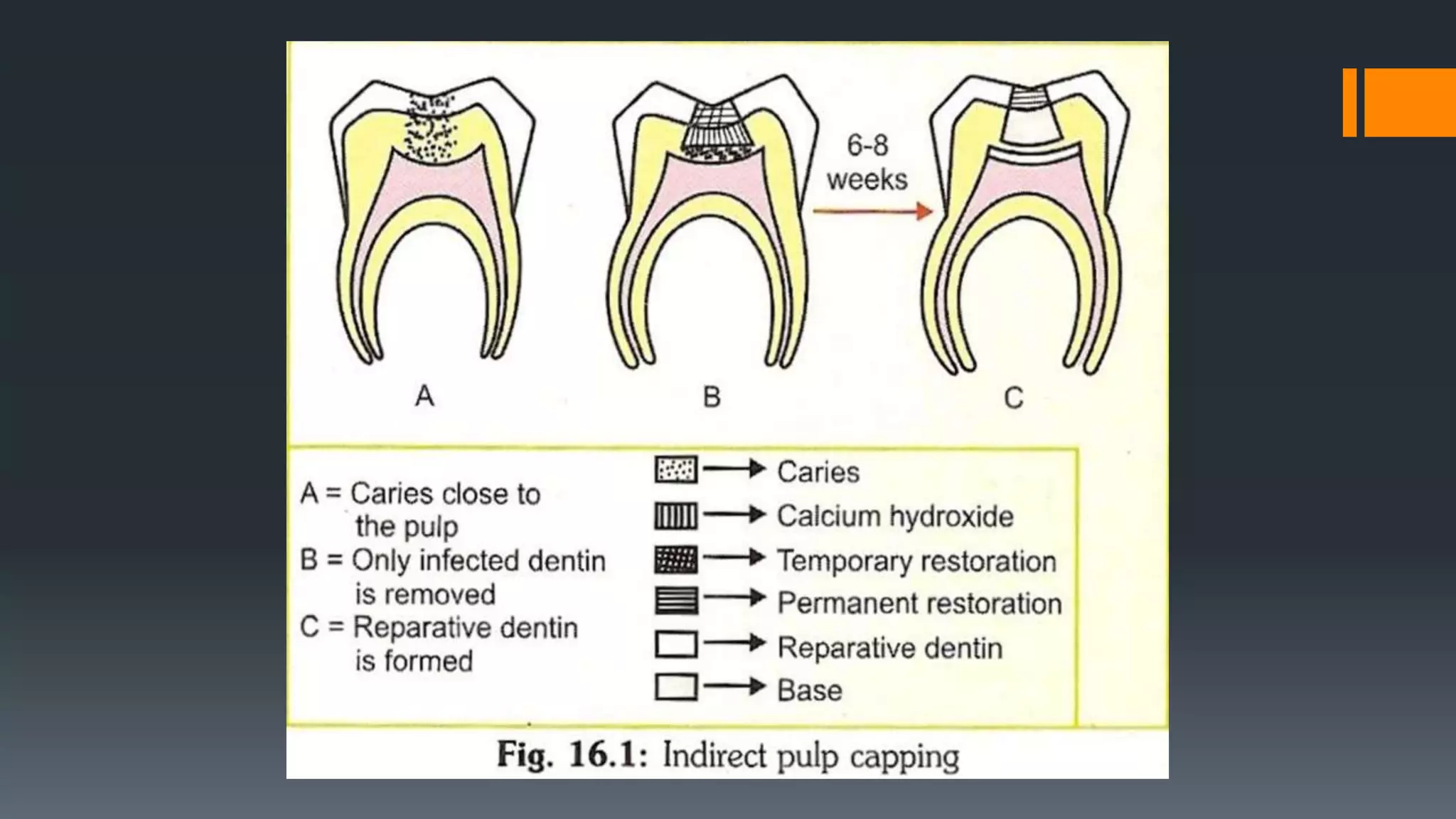Pulp capping agents | PPTX