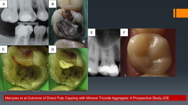Pulp capping agents | PPTX | Dental Health | Diseases and Conditions