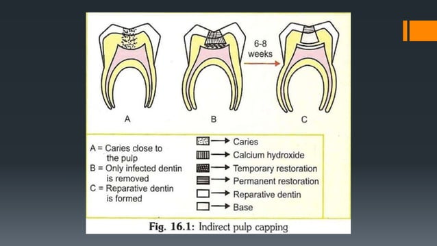 Pulp capping agents | PPTX | Dental Health | Diseases and Conditions