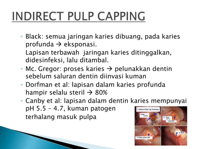 Pulp capping fix | PPTX