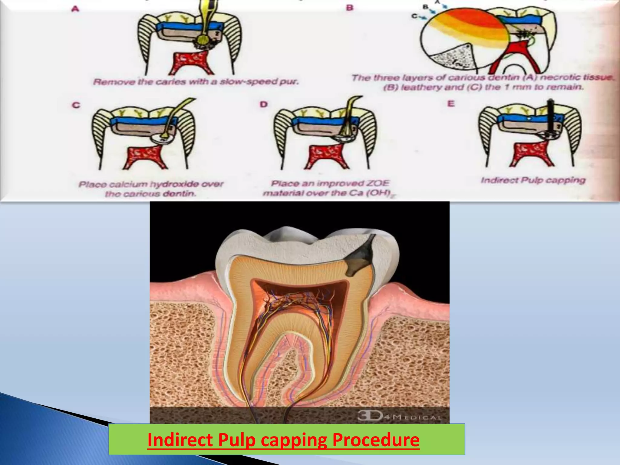 Pulp capping | PPTX