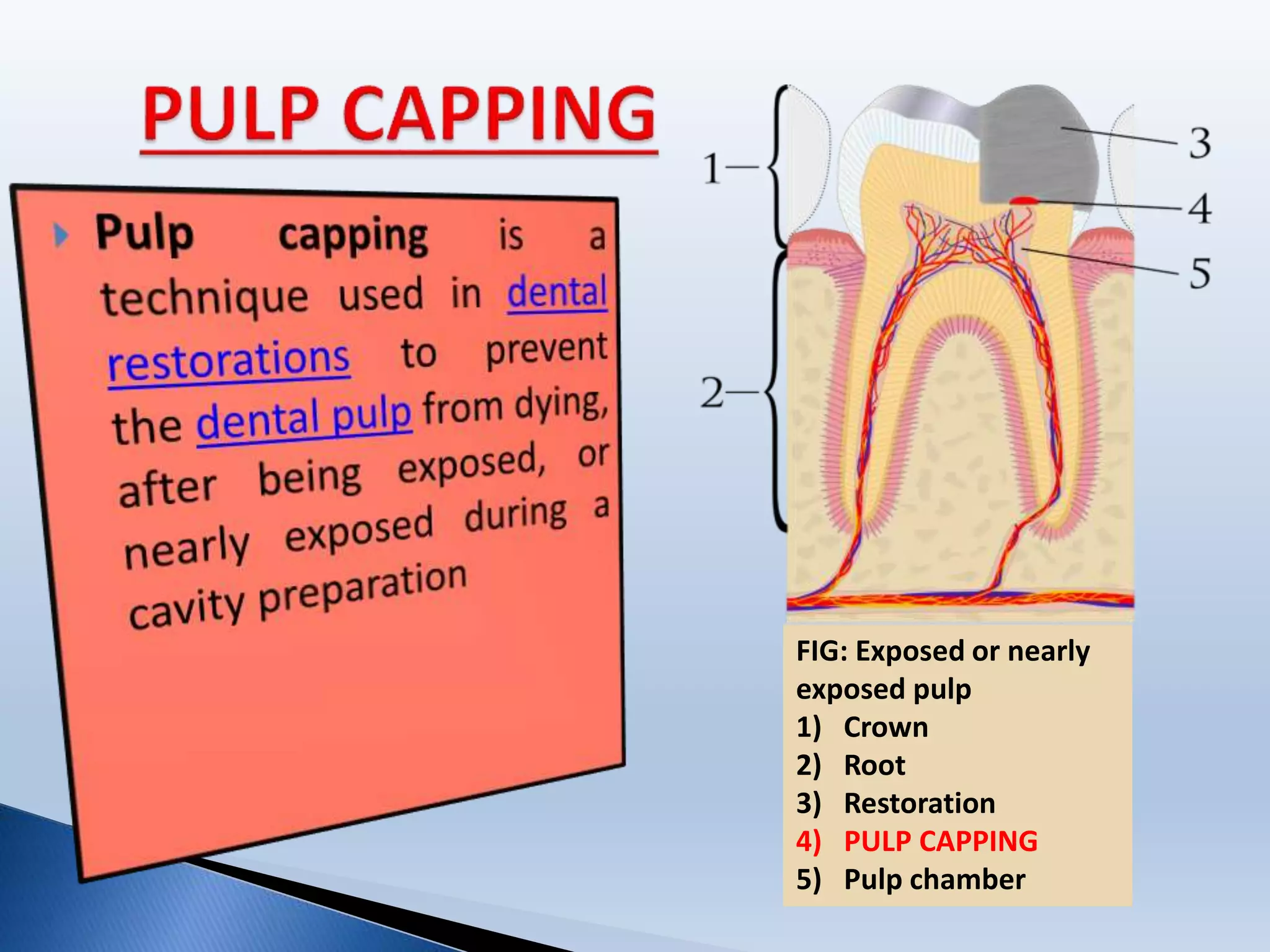 Pulp capping | PPTX