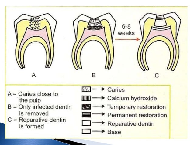 Pulp capping | PPTX