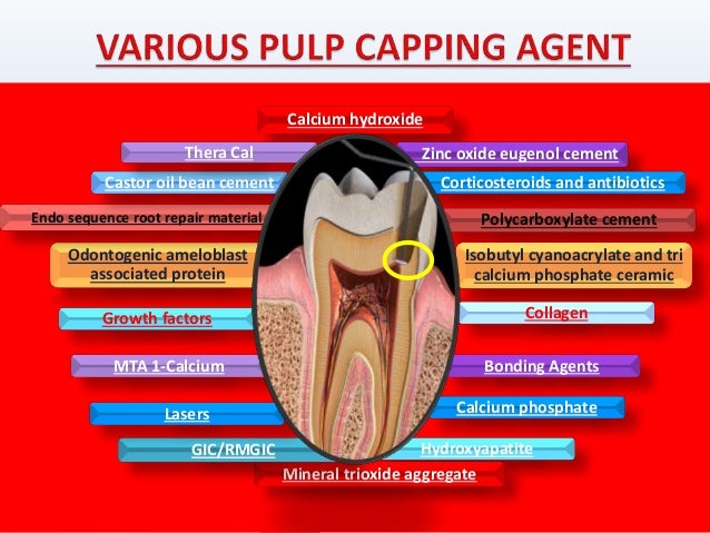 Pulp capping