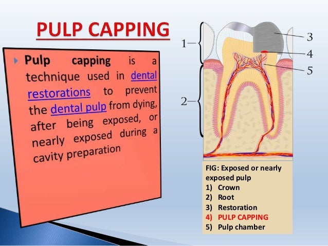 Pulp capping