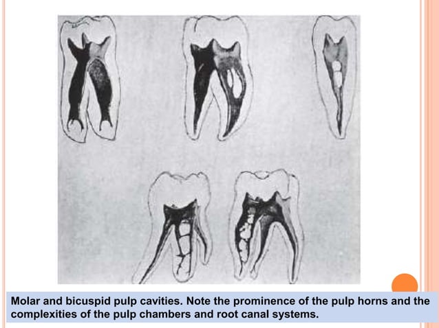Pulp cavities | PPTX | Dental Health | Diseases and Conditions