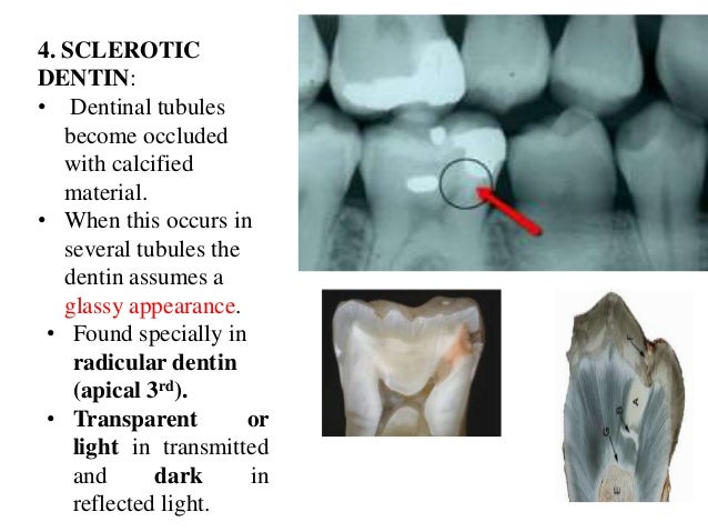 Sclerotic Dentin