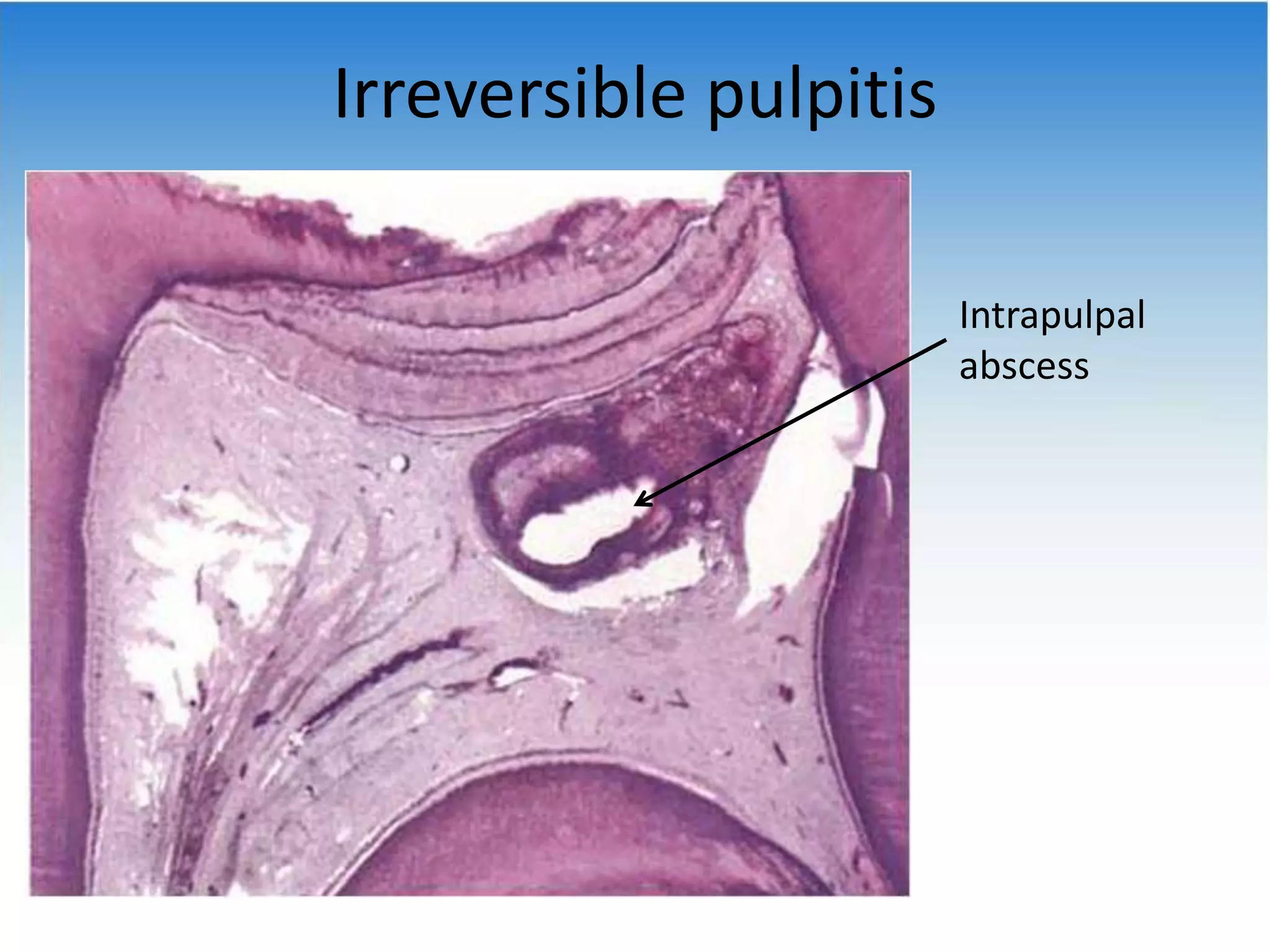 Pulp diseases | PPTX
