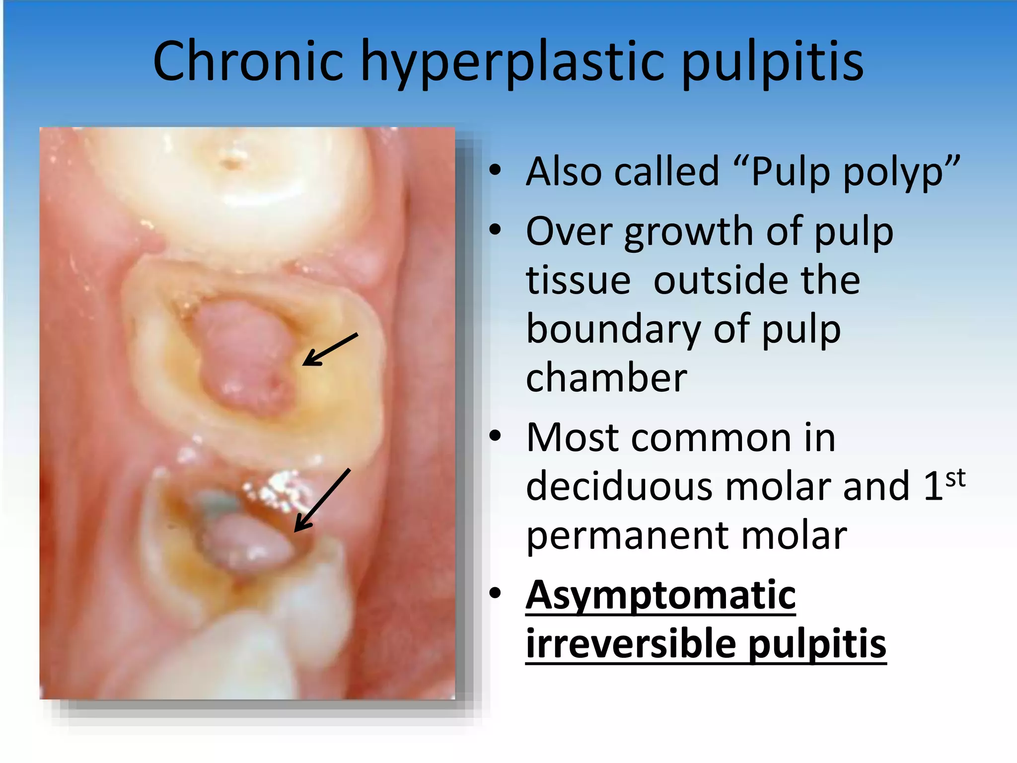 Pulp diseases | PPTX