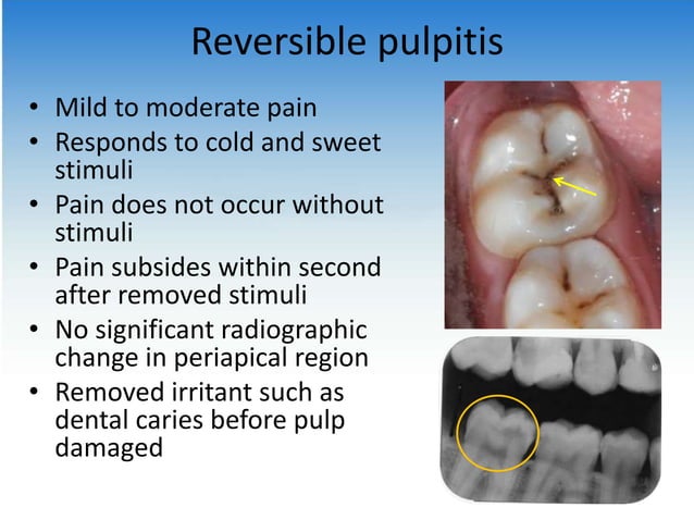 Pulp Diseases Ppt