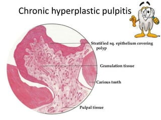 Chronic Hyperplastic Pulpitis