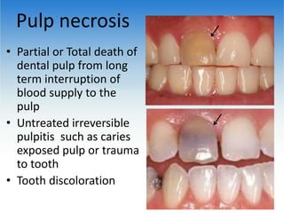 Pulp diseases | PPTX
