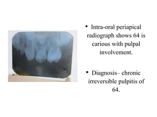 Pulpectomy | PPTX | Dental Health | Diseases and Conditions