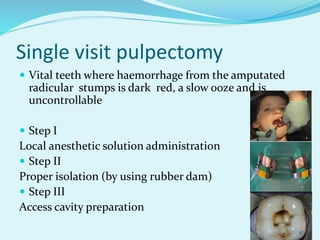 Pulpectomy | PPTX