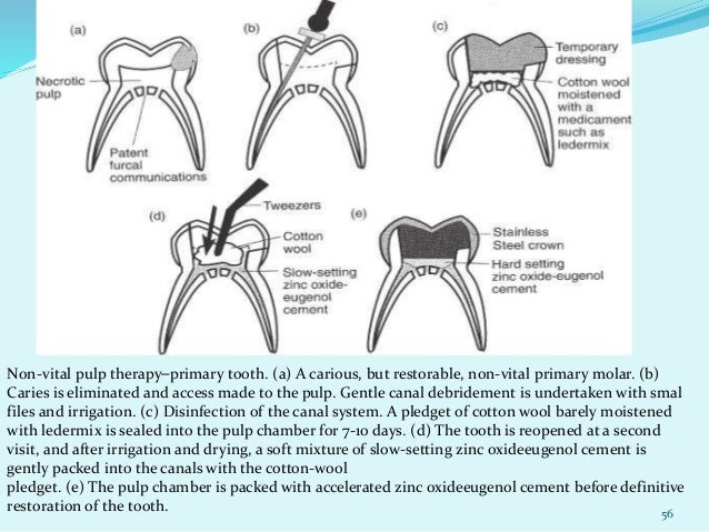 Pulpectomy