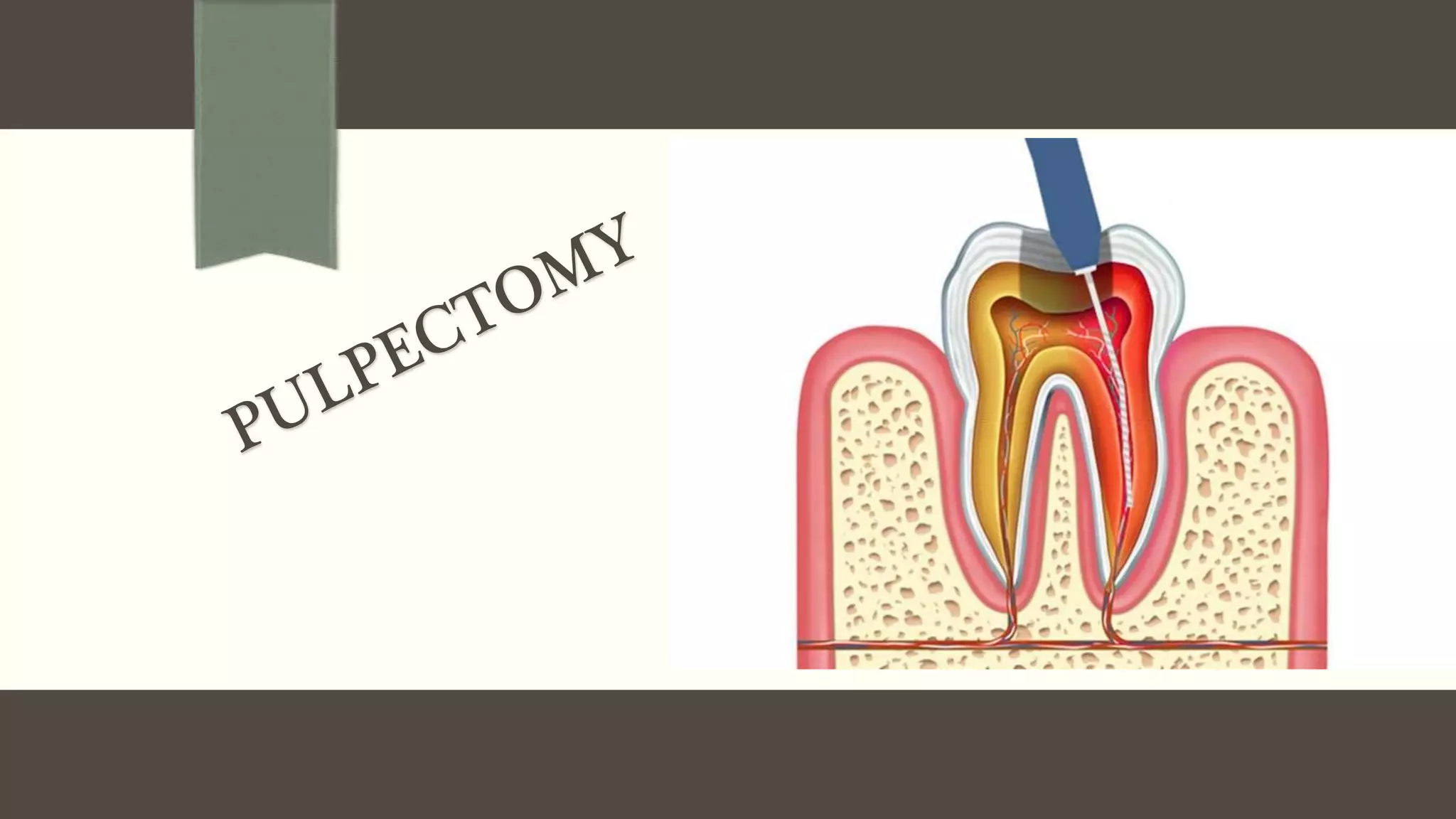 Pulpectomy | PPTX | Dental Health | Diseases and Conditions