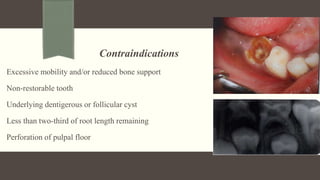 Pulpectomy | PPTX