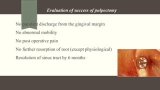 Pulpectomy | PPT