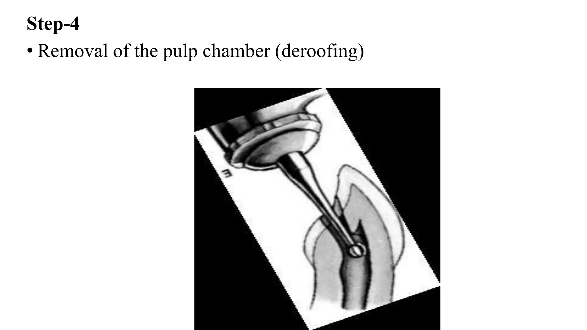 Pulpectomy copy | PPTX