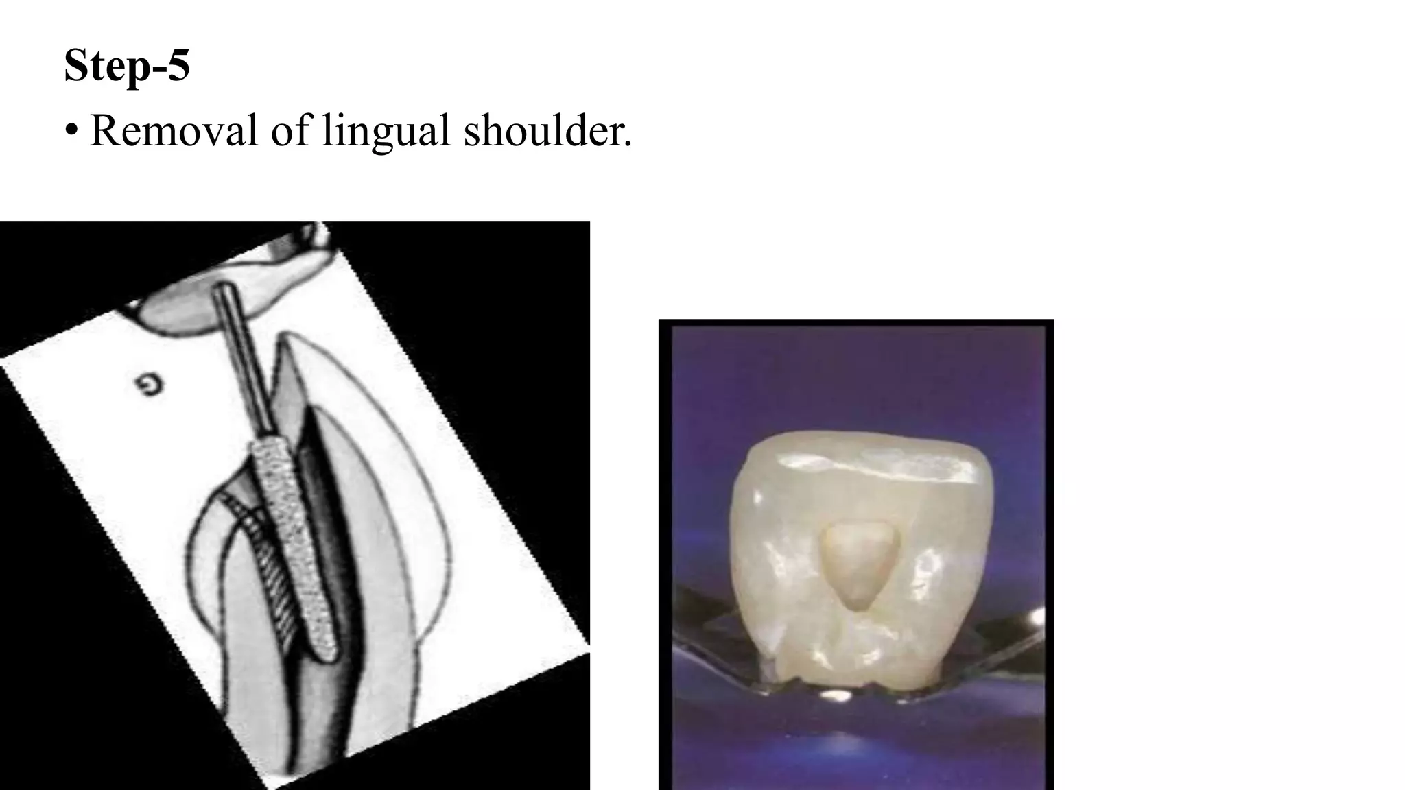 Pulpectomy copy | PPTX