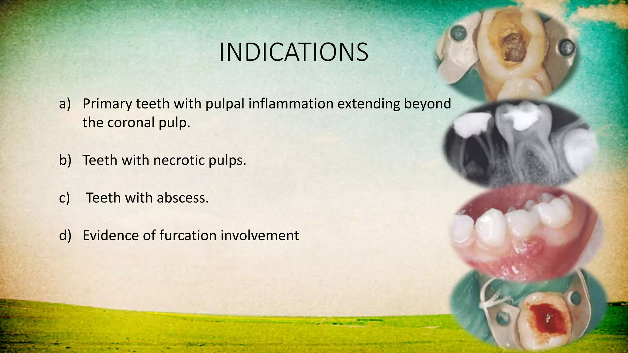 Pulpectomy copy | PPTX