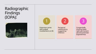 Internship Case Study: Managing a Pulpectomy in a Child with Agenesis ...