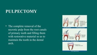 PULPECTOMY on Deciduous or primary tooth .pptx