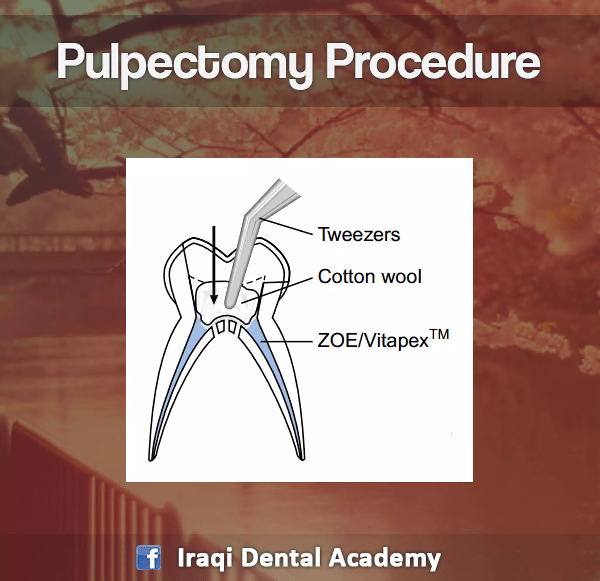 Pulpectomy Procedure Explained in brief | PDF