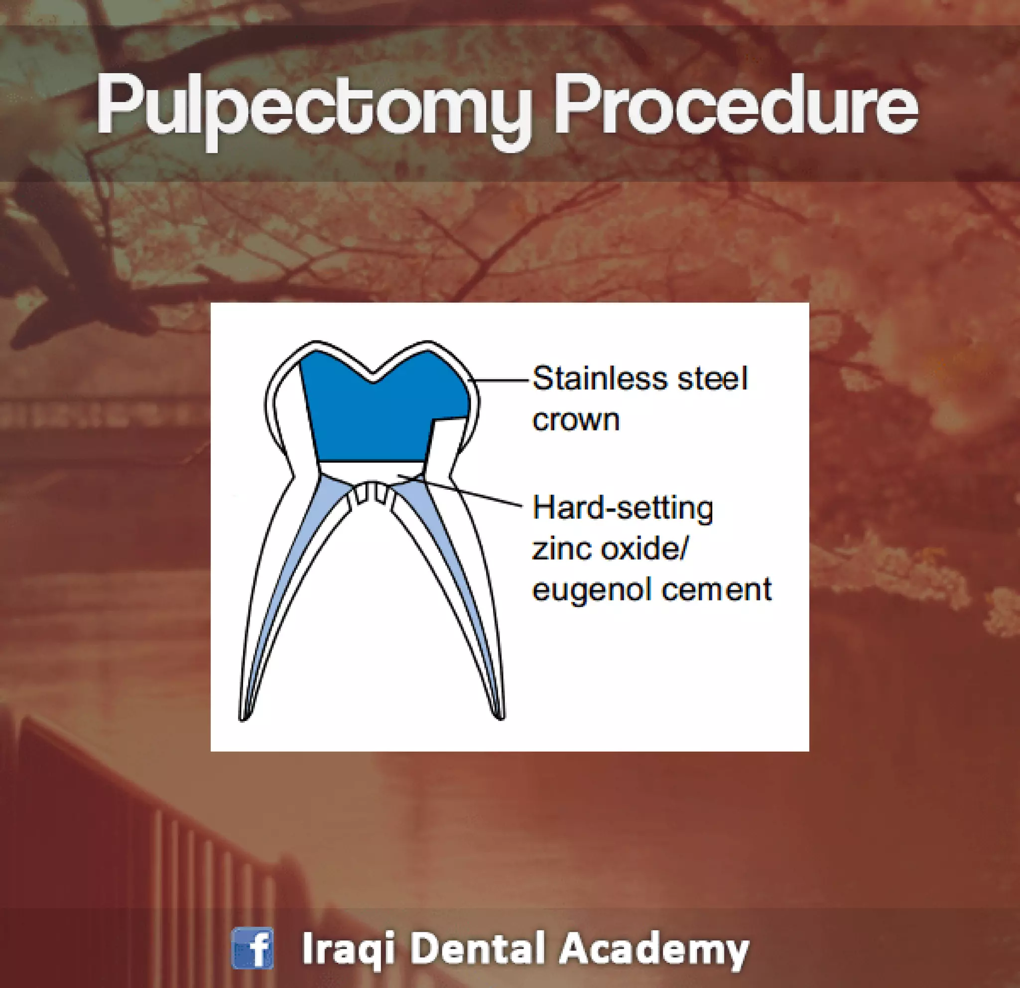 Pulpectomy Procedure Explained in brief | PDF
