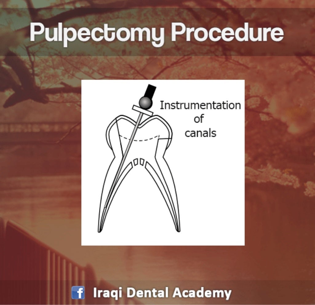 Pulpectomy Procedure Explained in brief