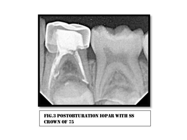 Pulpectomy with ss crown case 3 | PPTX