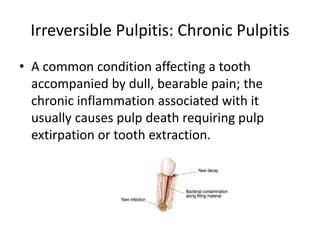 Pulpitis OD | PPT