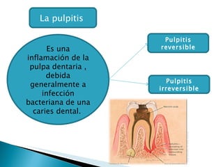 Pulpitis | PPT