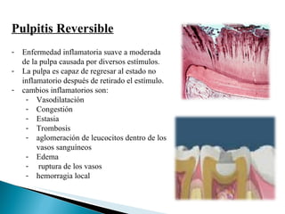 Pulpitis | PPT