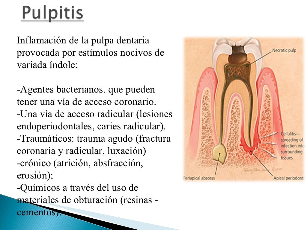 Pulpitis
