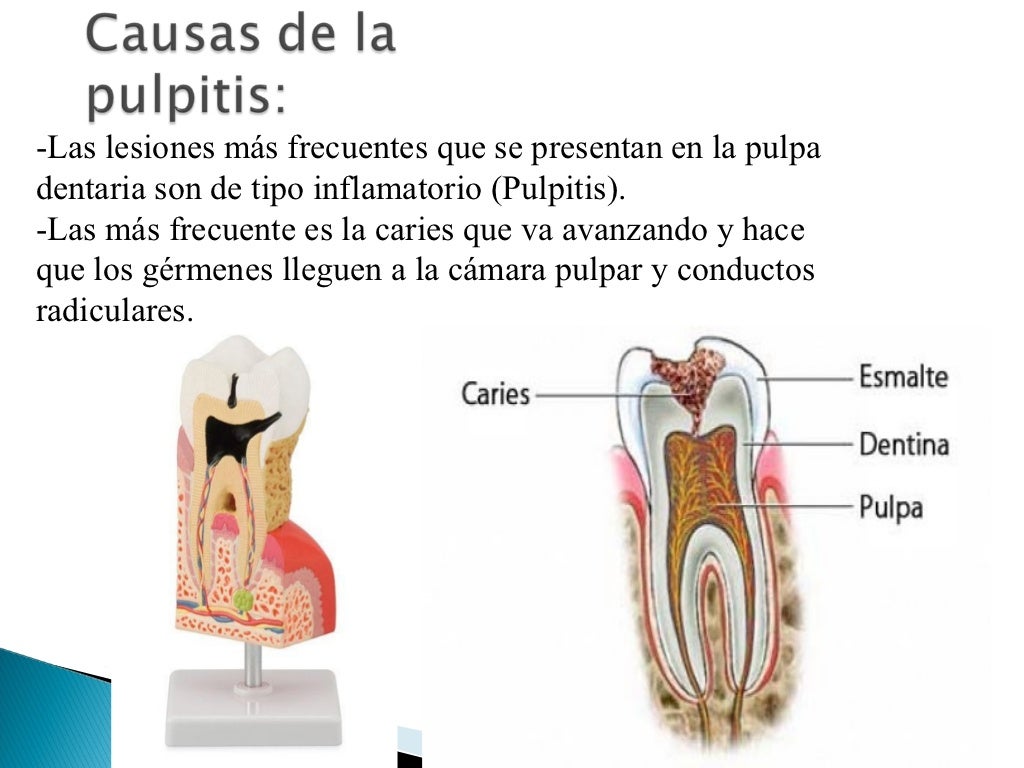 Pulpitis