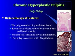 Chronic Hyperplastic Pulpitis