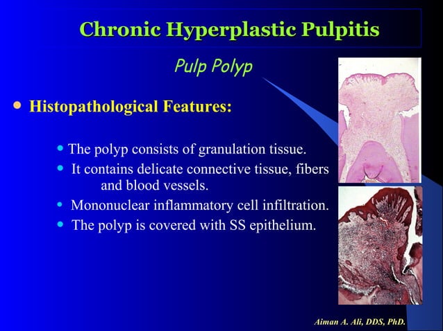 Pulpitis | PPT