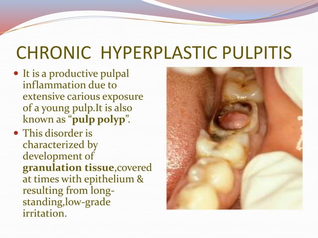 Pulpitis | PPTX | Dental Health | Diseases and Conditions